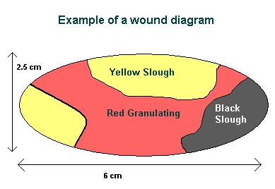 Fibrin Wound
